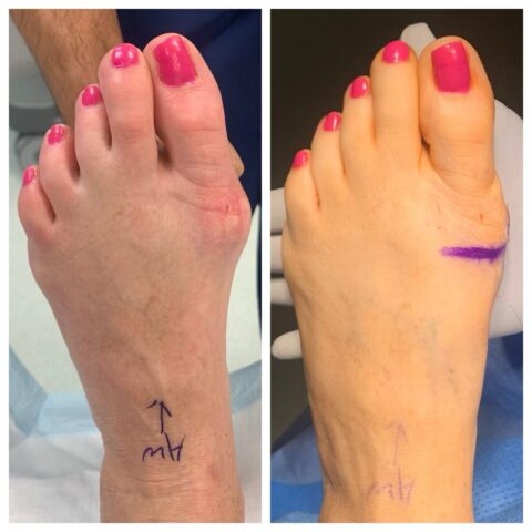 Minimally Invasive Bunion Surgery at Insight Orthopedics & Sports ...